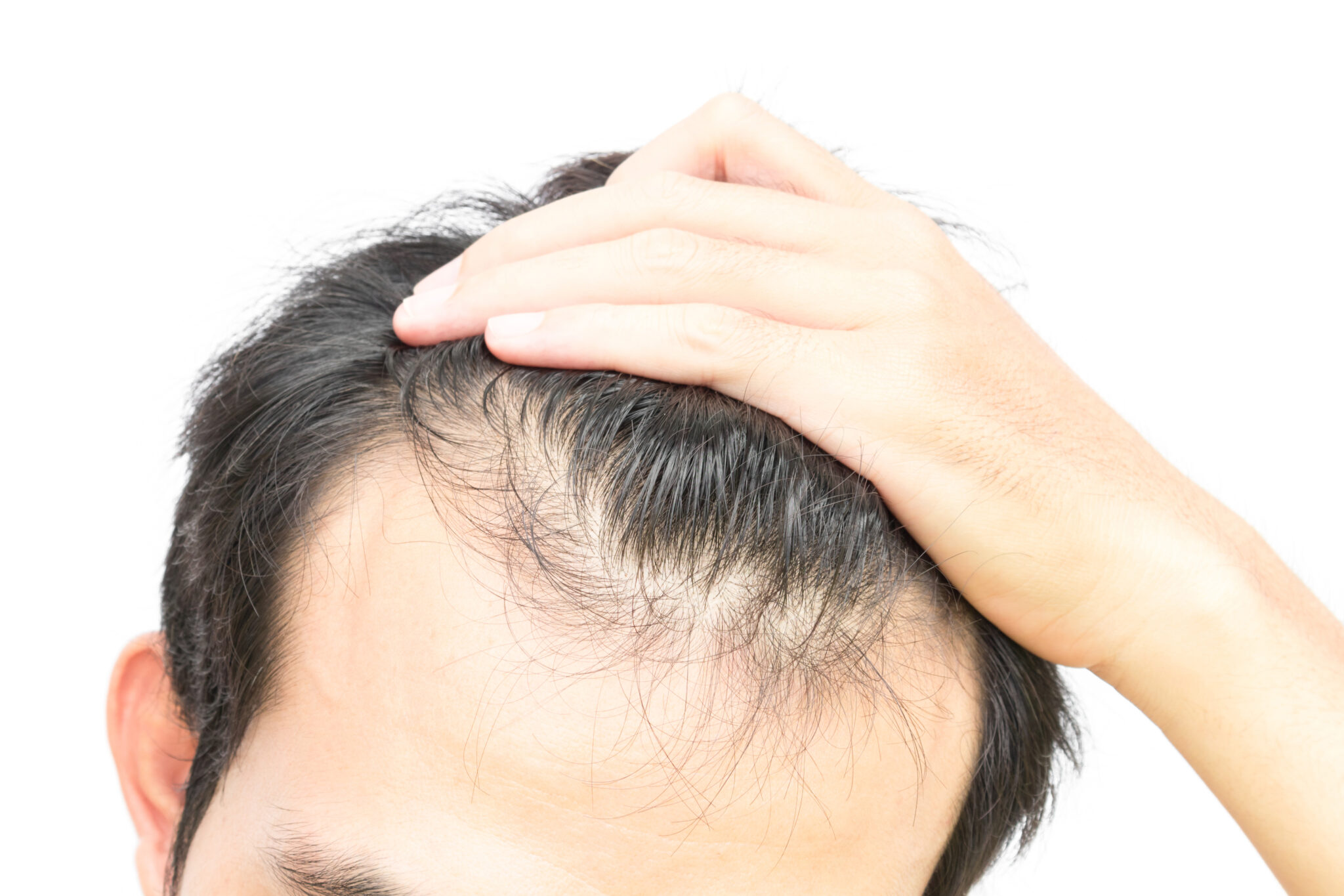 Receding Hairline: signs, causes, treatment in Turkey + B/A photos ...