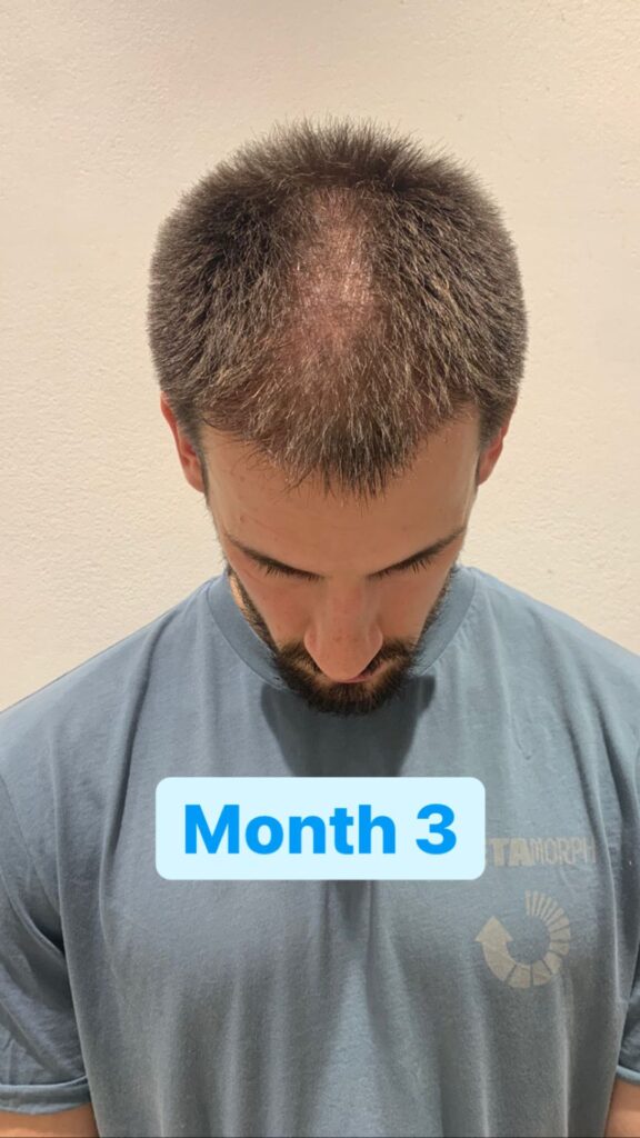 One Month After Hair Transplant Surgery - Estenove
