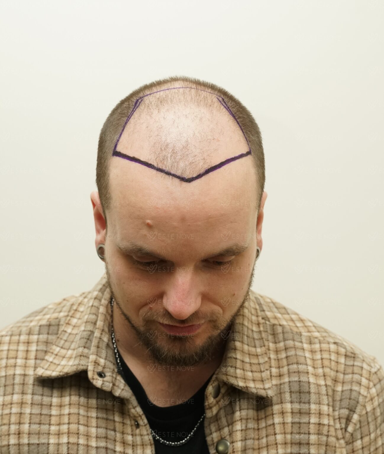 Hair Density: What It Means, How to Measure & Ways to Improve - Estenove