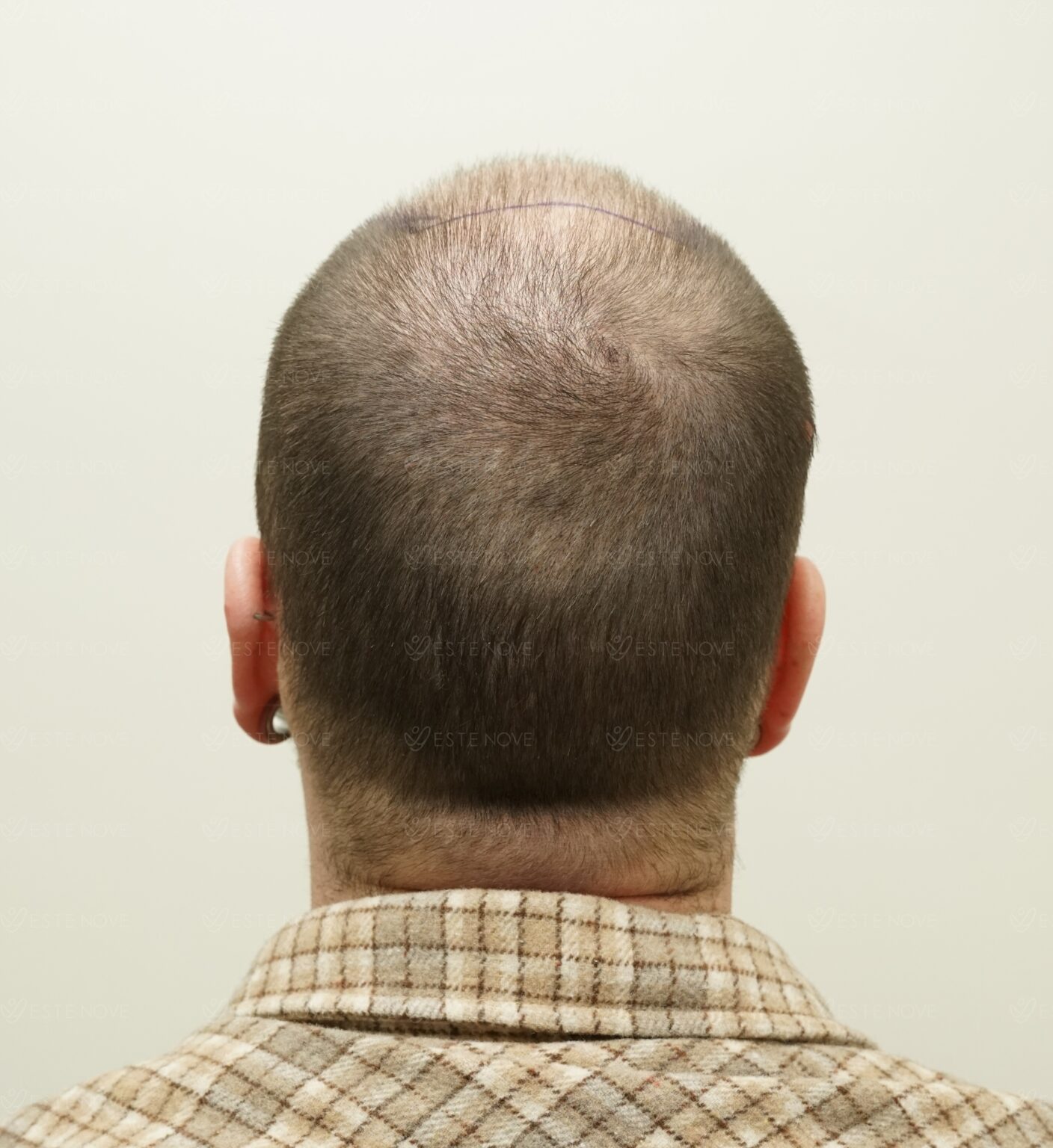 Hair Density: What It Means, How to Measure & Ways to Improve - Estenove