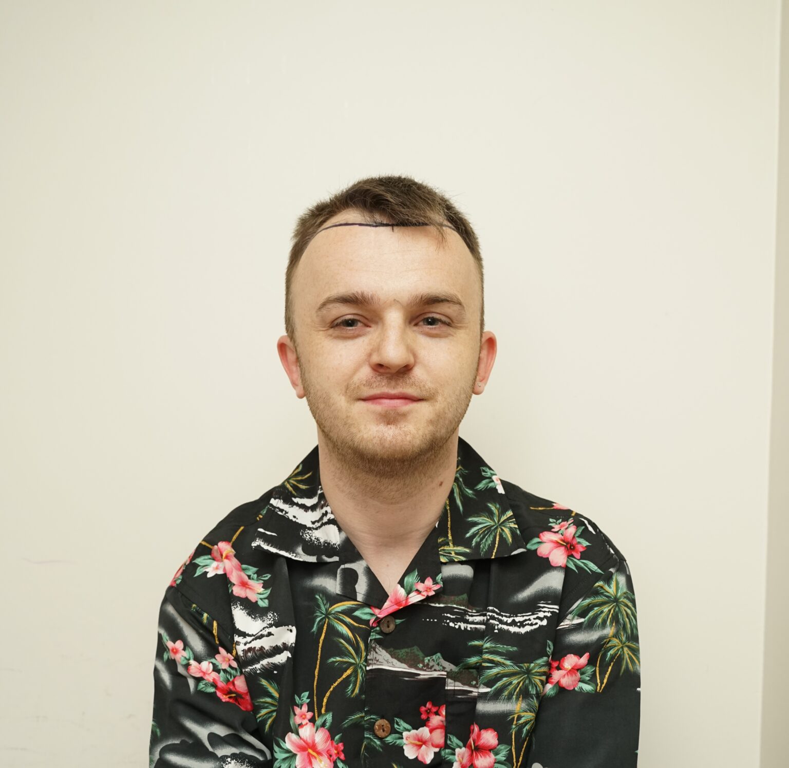 Hair Density: What It Means, How to Measure & Ways to Improve - Estenove