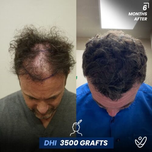 Hair Transplant Recovery Timeline (1 to 12 Month) - Estenove