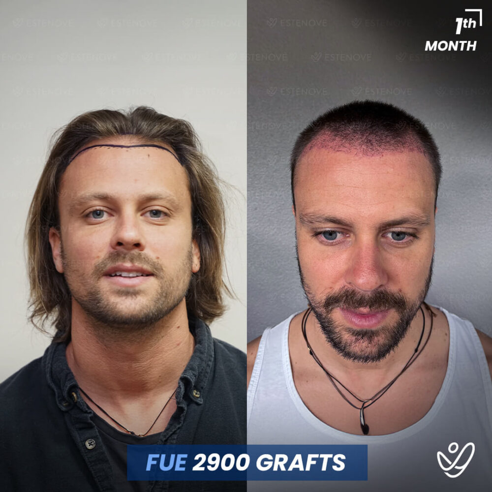 Hair Transplant Month by Month (1-12 B&A Photos) - Estenove