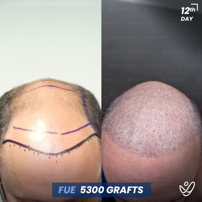 Hair Transplant Month by Month (1-12 B&A Photos) - Estenove