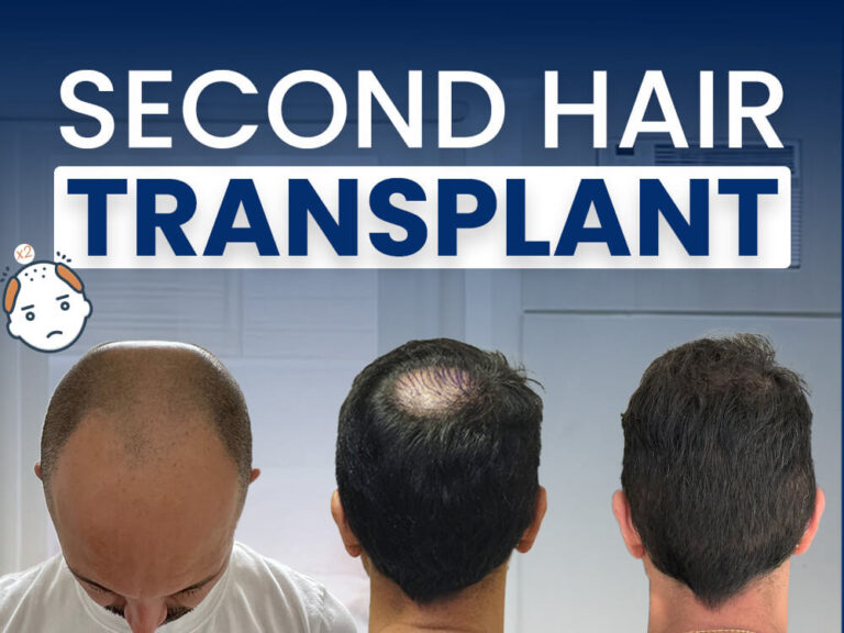 Second Hair Transplants Explained - Estenove Second Hair Transplants Explained - Estenove